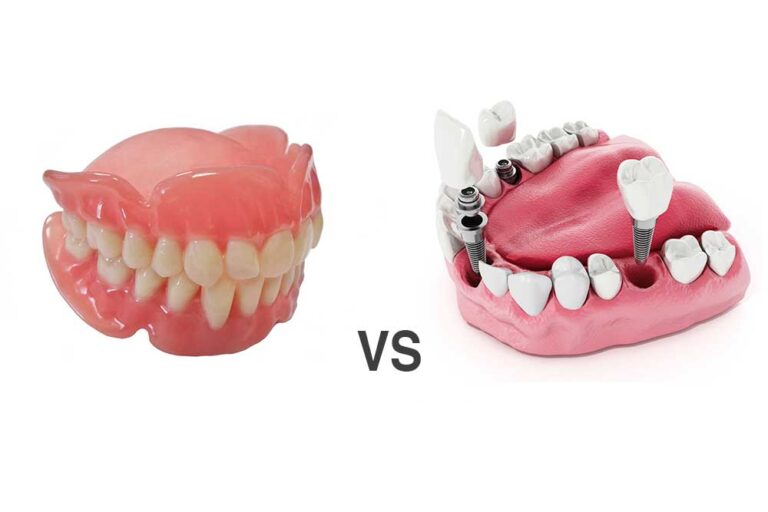 Dental Implants vs. Traditional Dentures: Which Is Better for Nigerian ...